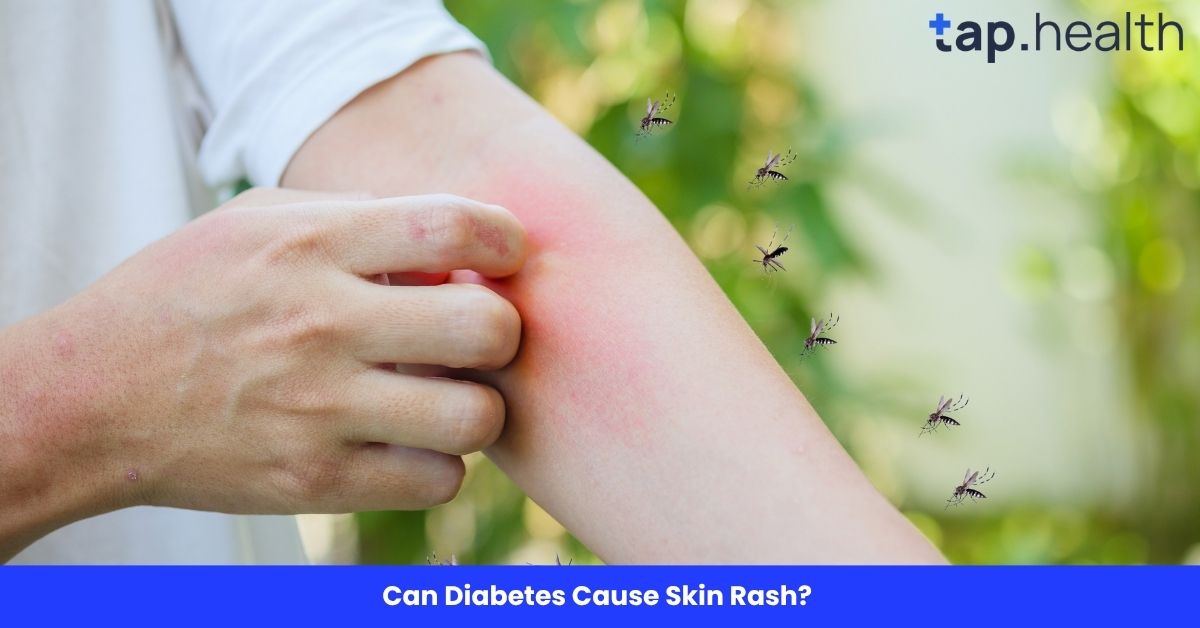 Can Diabetes Cause Skin Rash? Understanding Skin Problems and How to ...