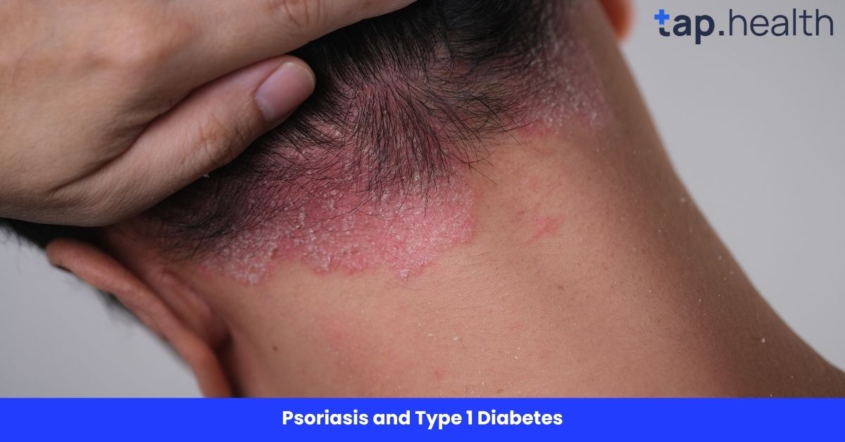 Psoriasis and Type 1 Diabetes: Understanding the Link, Treatment ...